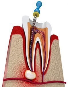 Endodontie – Zahnarztpraxis Sudian